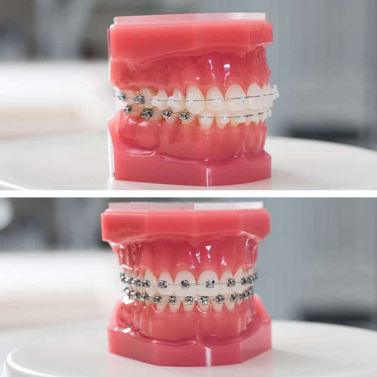 Zahnspangen - Fachpraxis für Kieferorthopädie