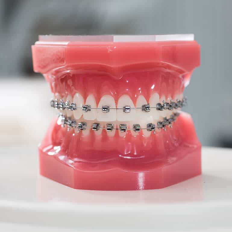 Zahnspangen - Fachpraxis für Kieferorthopädie